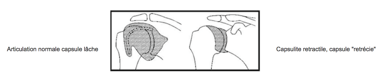 Capsulite rétractile de l’épaule – arthropole